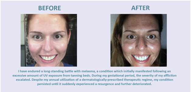 Meladerm For Treating Melasma
